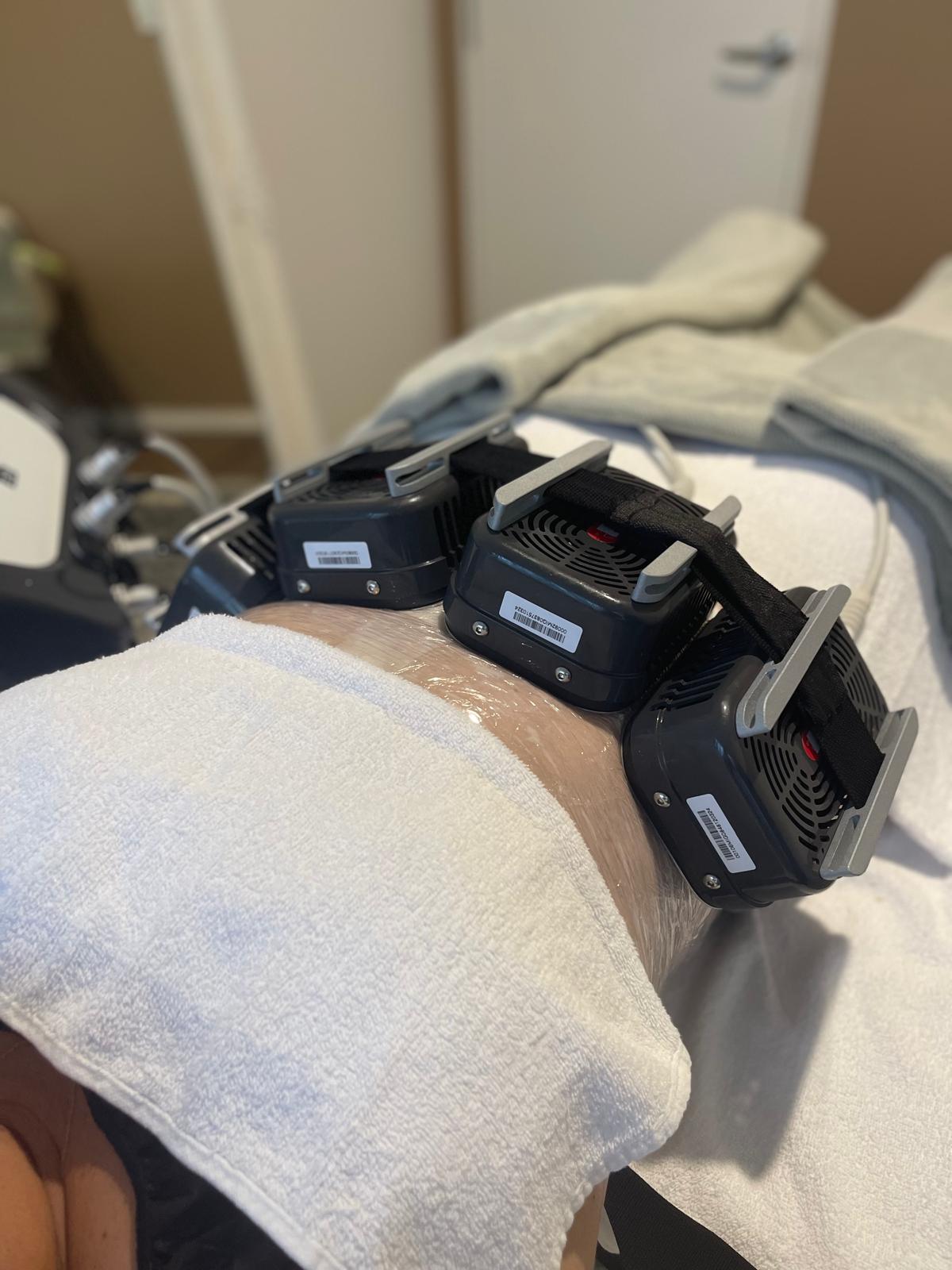 Fat Freezing Auckland - Azalea Therapy And SPA